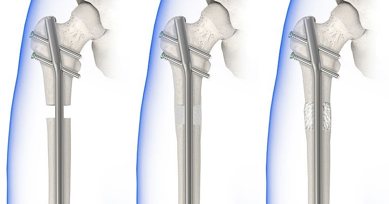 Height Lengthening Surgery Expectations