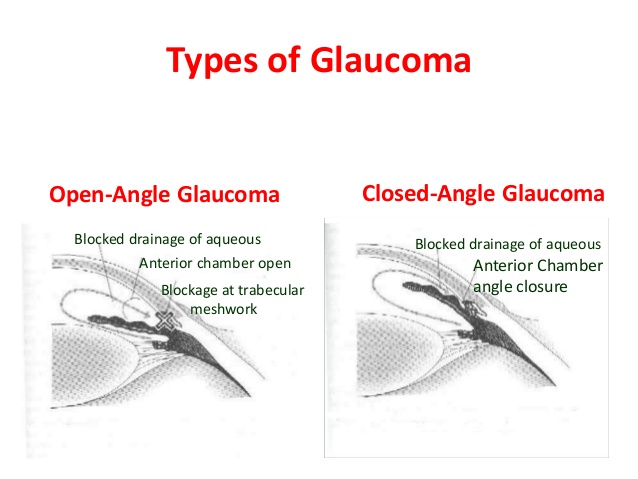 Best Guide on Glaucoma and How to Avoid Permanent Loss of Vision ...