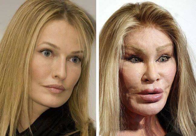 Plastic Surgery Disasters Before And After