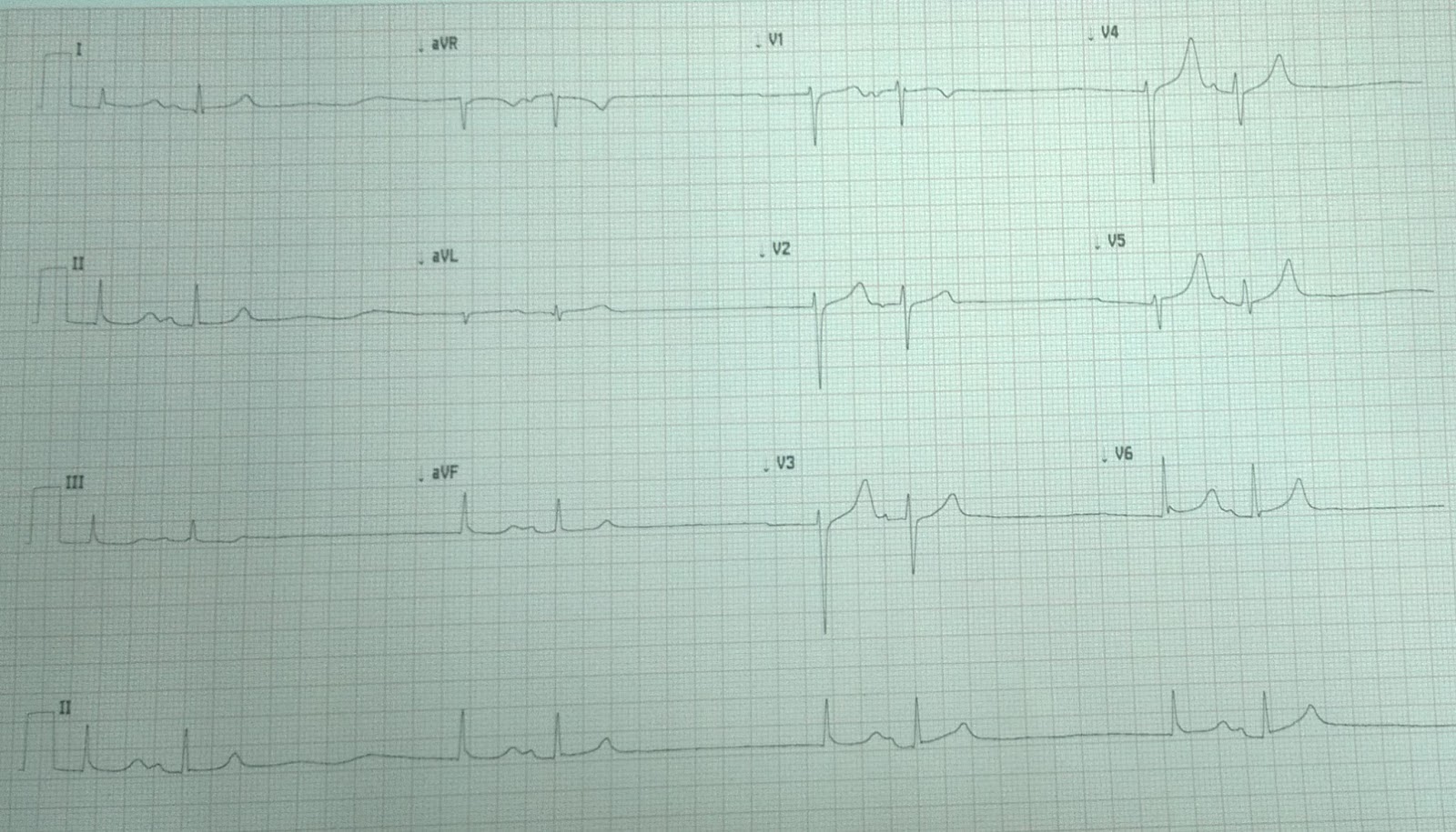 Cardiology window: ECG Sinus node dysfunction