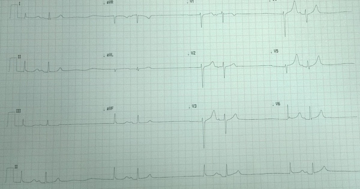 Cardiology window: ECG Sinus node dysfunction