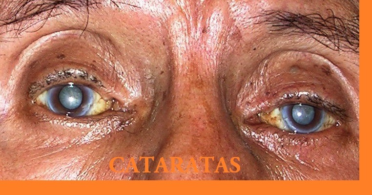 EL RINCON DE VANEXA: CATARATAS: DEFINICIÓN Y TIPOS