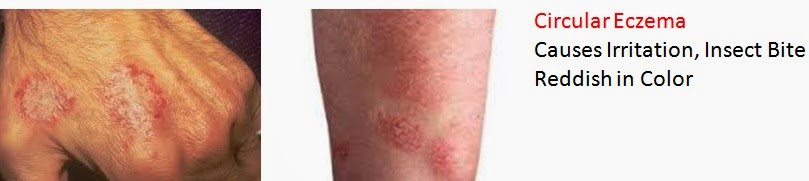 medi doctorz: Circular Eczema Understanding Discoid Dermatitis