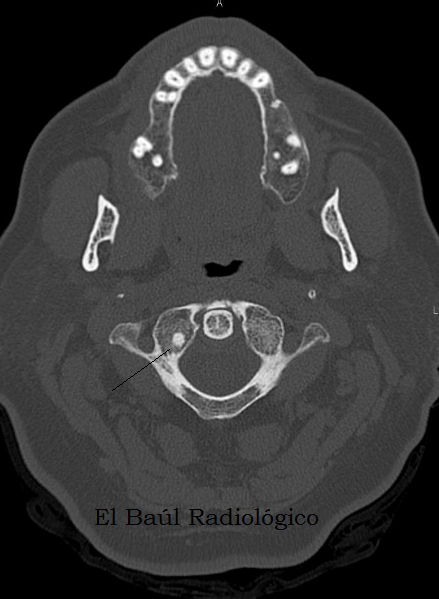 El Baúl Radiológico: ENOSTOSIS: ISLOTE ÓSEO (Bone Island: CT and MRI ...