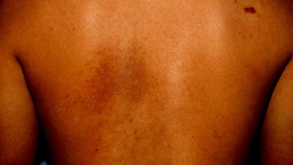 Notalgia paresthetica