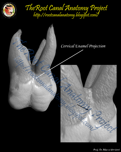 The Root Canal Anatomy Project: Maxillary First Molar: Five Canals
