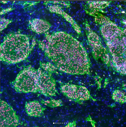 How to Spot and Avoid Dangerous Stem Cell Scams for the Eye - Eyedolatry