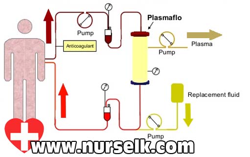 Plasmapheresis Process