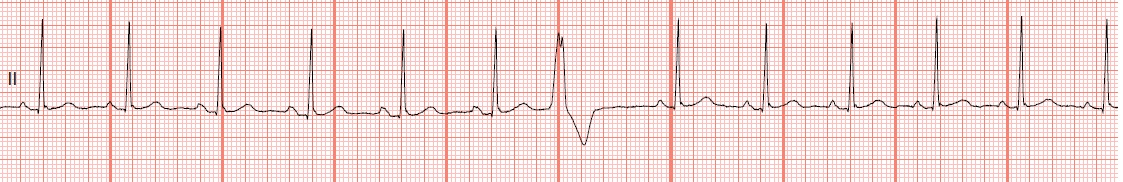 EKG Rhythm Strip Quiz 38