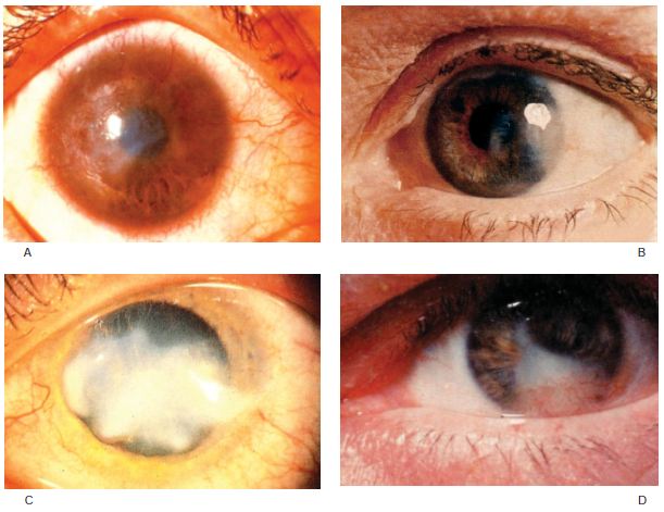 Ophthalmology | Ophthalmologist: CORNEAL OPACITIES