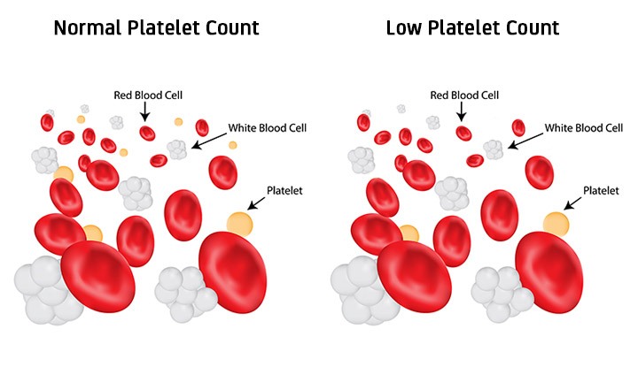 Ini Bahayanya Ketika Jumlah Sel Trombosit Terlalu Rendah