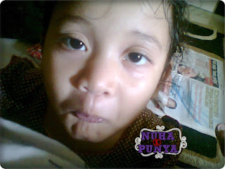 The Apple of Our Eyes: N.U.H.A bila....Muka Buruk