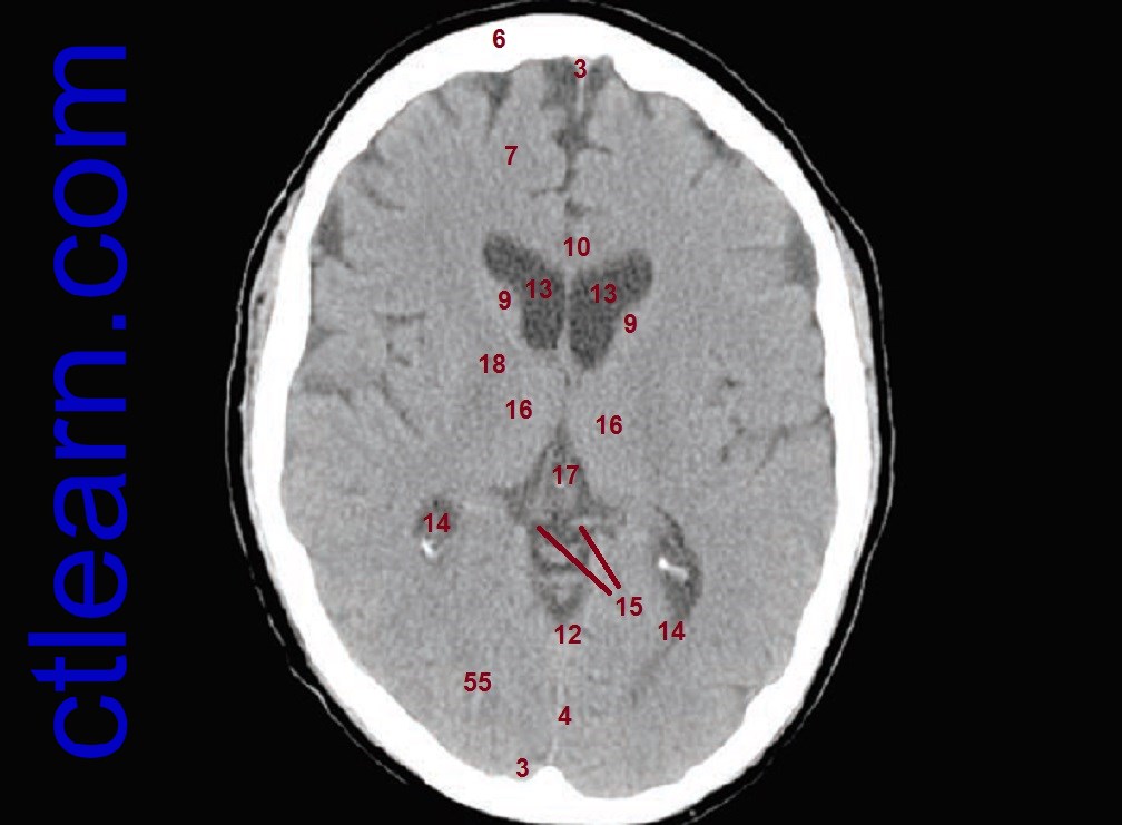 Anatomy CT Axial Brain