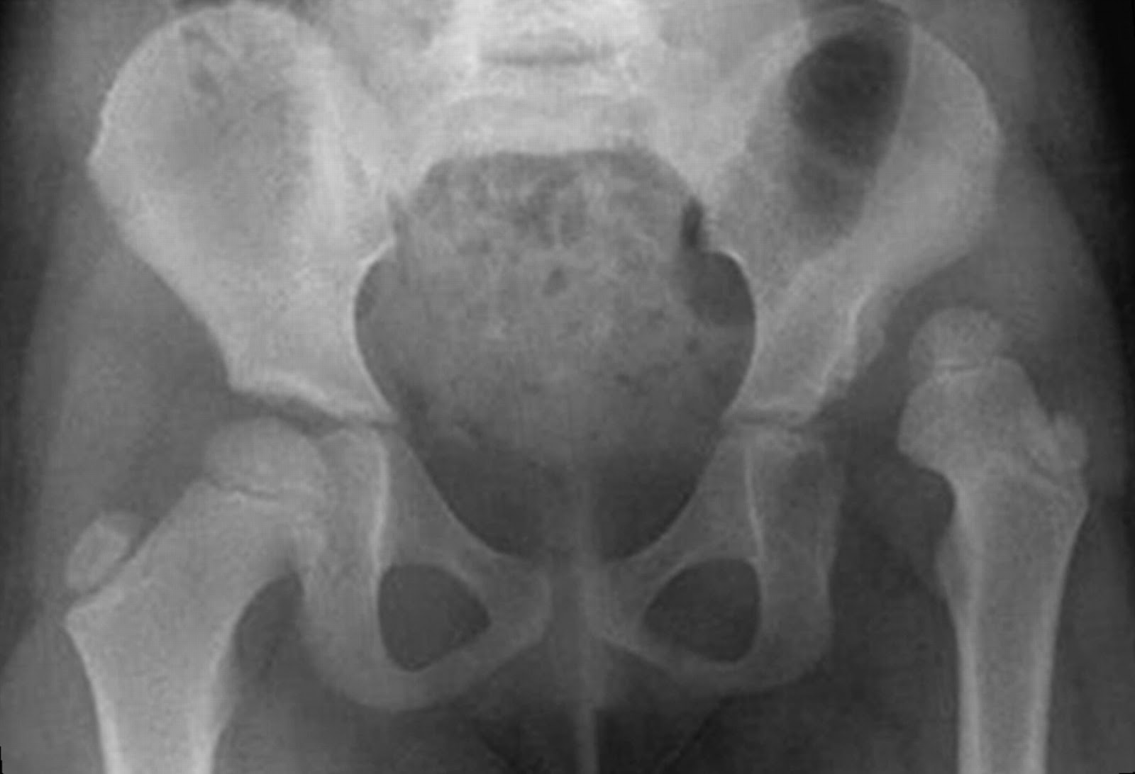 DISPLASIA CONGENITA DE QUADRIL PDF