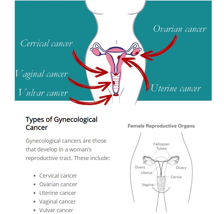 Gynecological Cancer Awareness Month: What You Need To Know!