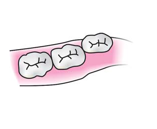 Classification of impacted mandibular third molar