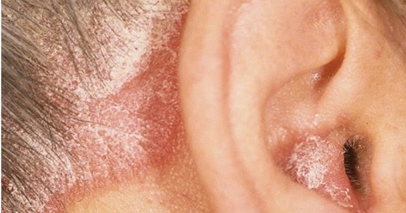 ¿COMO IDENTIFICAR LOS SÍNTOMAS DE LA PSORIASIS EN OÍDO?