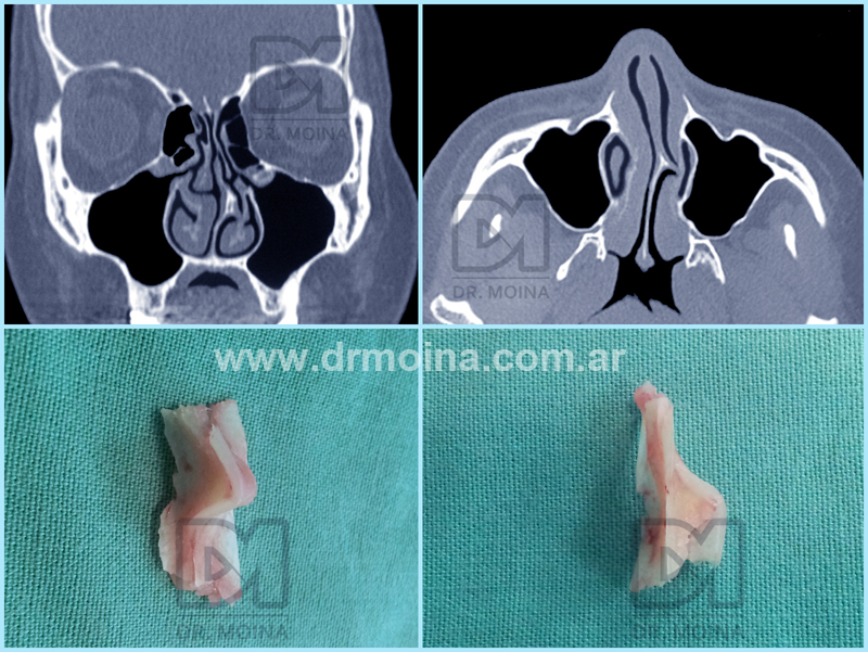 Rinoseptumplastia: Cresta o Espolón de Tabique o Septum Nasal