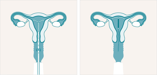 Clases de Medicina: DIU (DISPOSITVO INTRAUTERINO), METODO ...