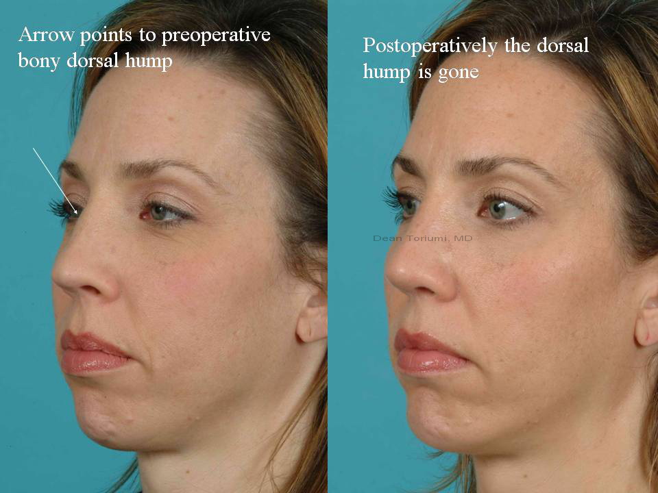 Dr. Dean Toriumi Reviews: Dean Toriumi Reviews: Patient presented with ...