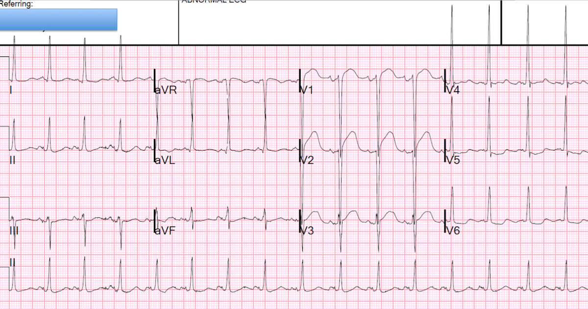 Dr. Smith's ECG Blog: A 60-something with Syncope, LVH, and convex ST ...