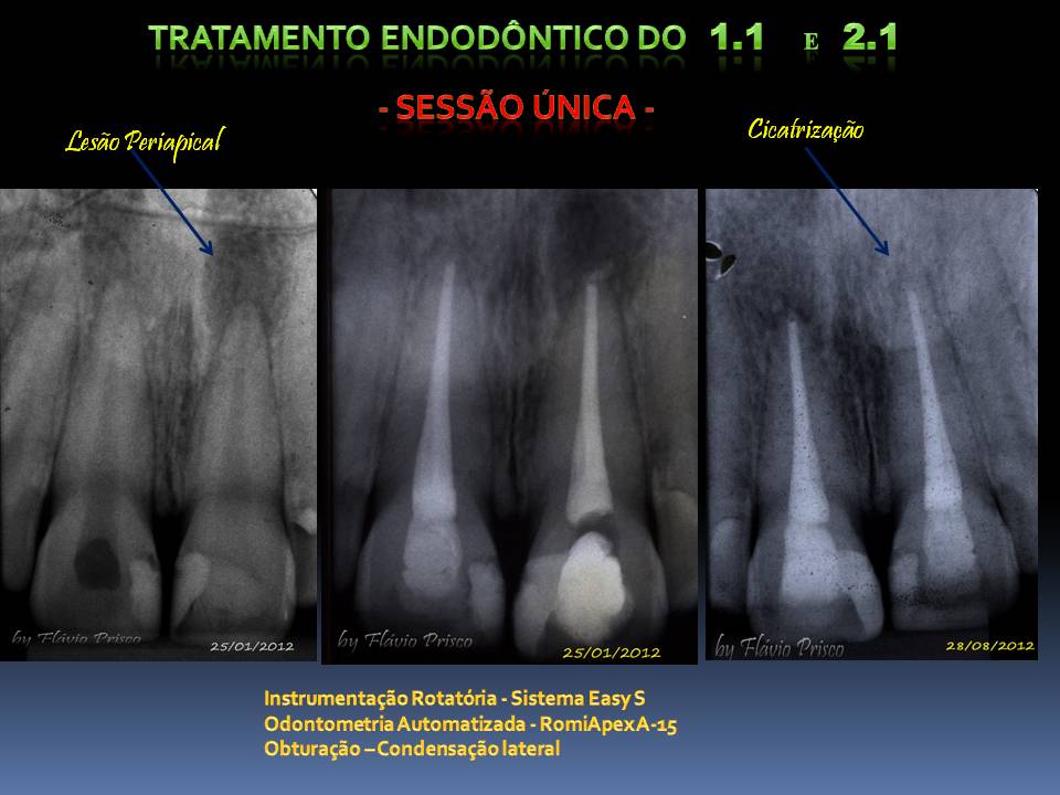 Descobrindo e explorando a Endodontia : Surplus ( " puff " )