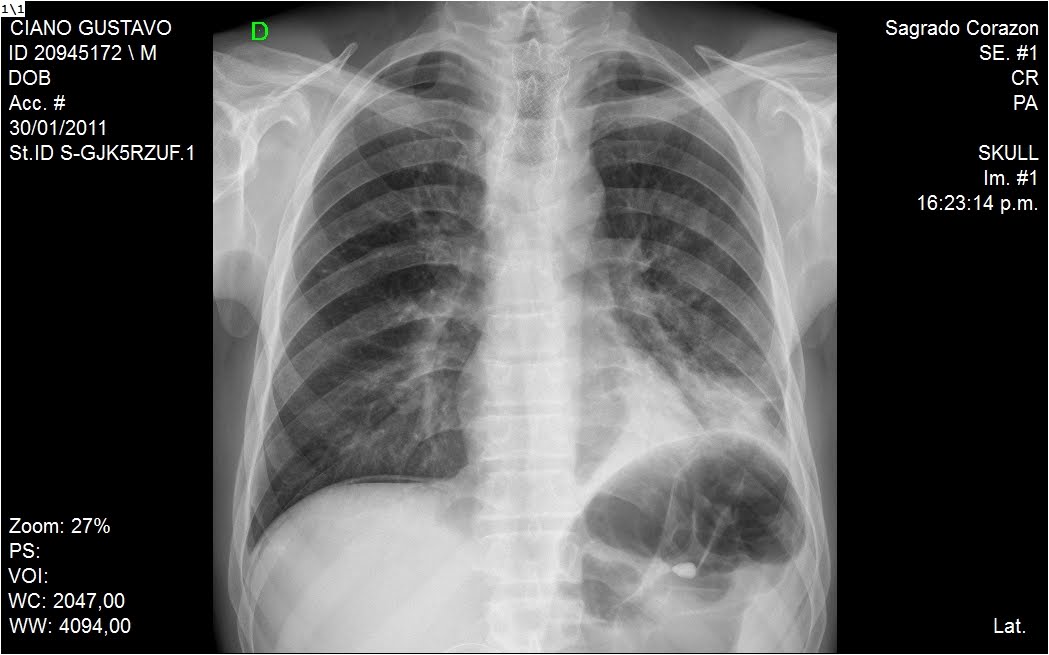 MEDICINA INTERNA Argentina: ¿NEUMONIA?