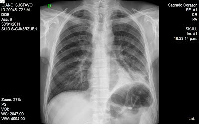 MEDICINA INTERNA Argentina: ¿NEUMONIA?