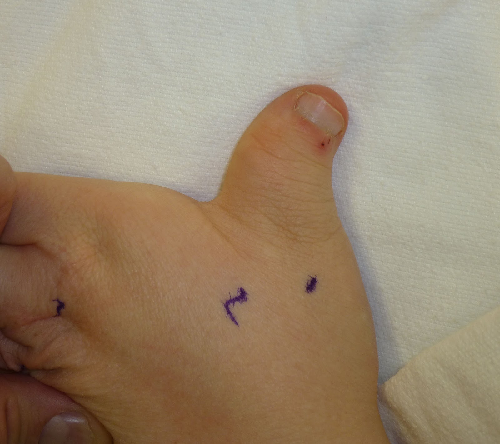 Carpenter Syndrome | Congenital Hand and Arm Differences | Washington ...