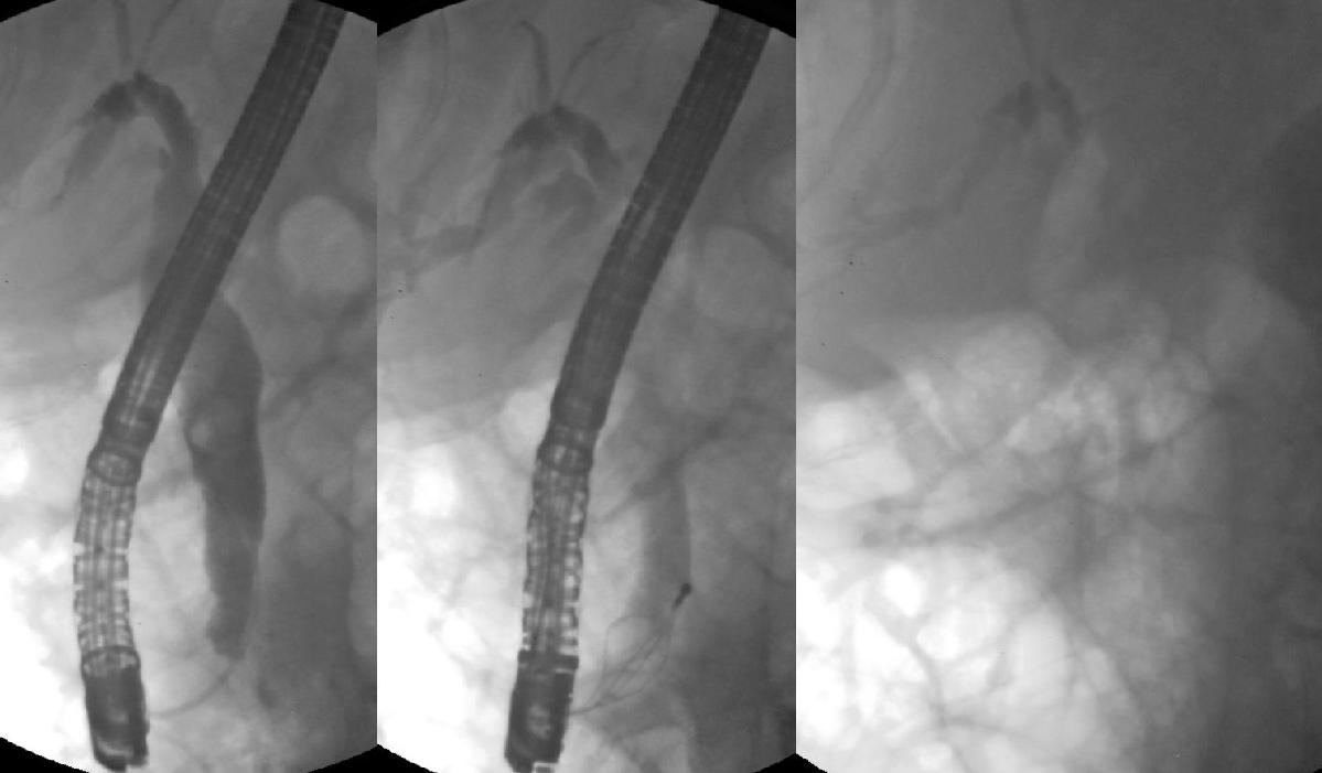 ENDOSCOPIA TERAPEUTICA Día a Día: Coledocolitiasis USE - CPRE