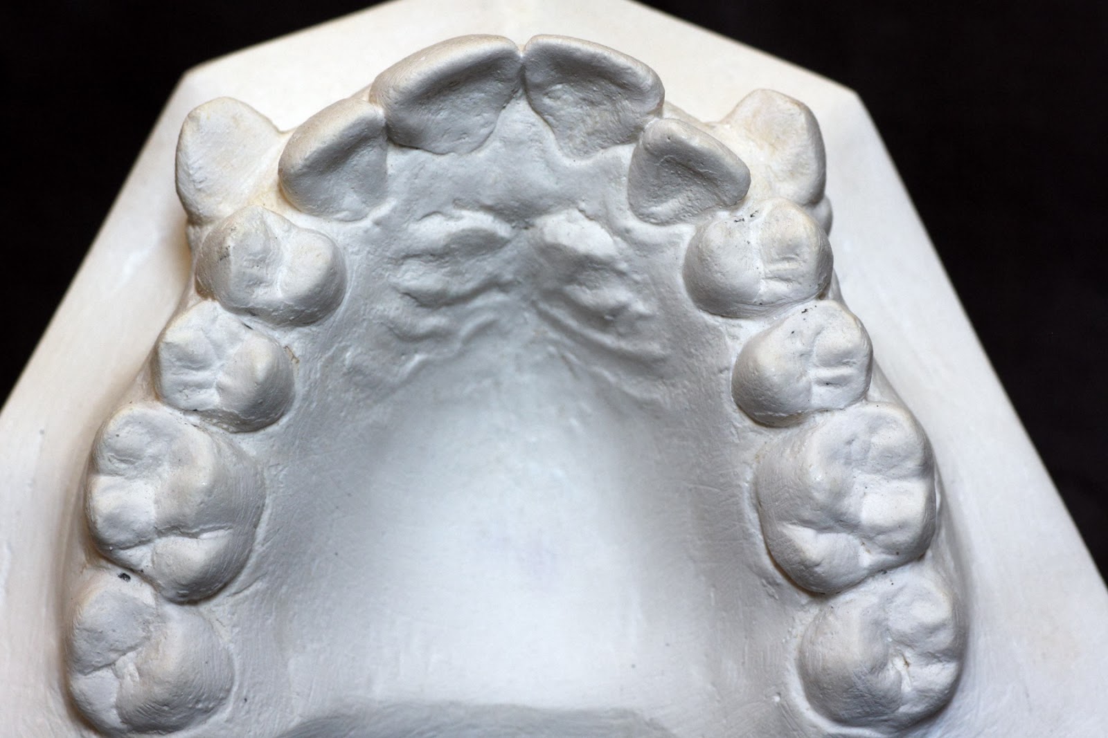 Orthodontics: UG Model Analysis Measurement of crowding and spacing