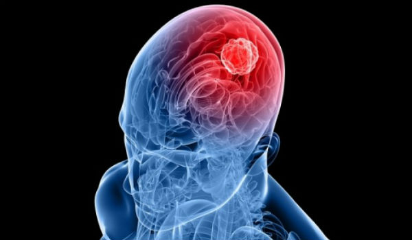 Επιληψία: Αίτια, συμπτώματα, παράγοντες κινδύνου και σωστή αντιμετώπιση