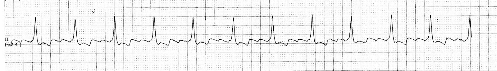 ECG Channel: Atrial Flutter