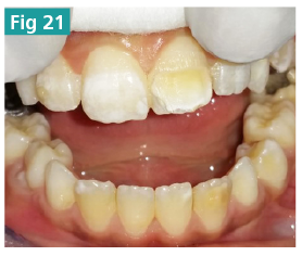 Molar Incisor Hypomineralization (MIH): Conservative Treatment Approach