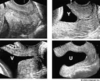 Mi Ginecólogo: Cervicometría