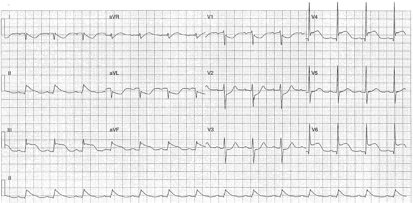 ECG of the Week: ECG of the Week - 6th July 2015 - Interpretation
