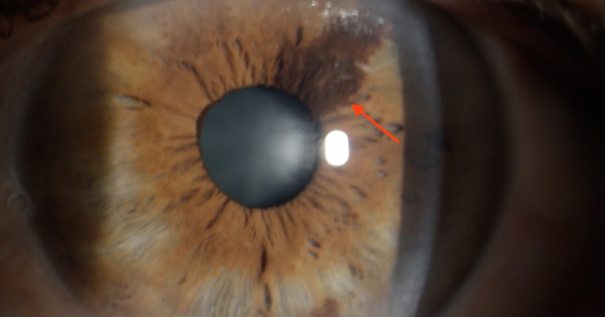 NEVUS DEL IRIS (2 FOTOS)