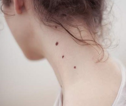 Photos of Moles on Face and Neck ~ How To Remove Moles, Warts, Skin ...