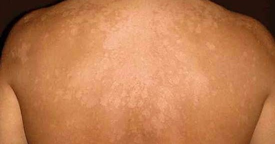 pendekarbertulangbelakang: penyebab dan cara menyembuhkan panu