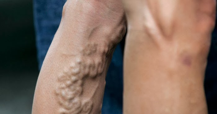 BERBAGI ILMU: MENGENAL VARISES