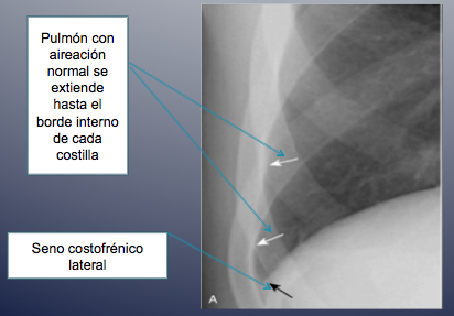 IDENTIFICACIÓN DE UN DERRAME PLEURAL: Ángulo costofrénico lateral ...