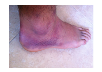 EL MUNDO DEL FUTBOL: CÓMO EVITAR LAS LESIONES DE TOBILLO