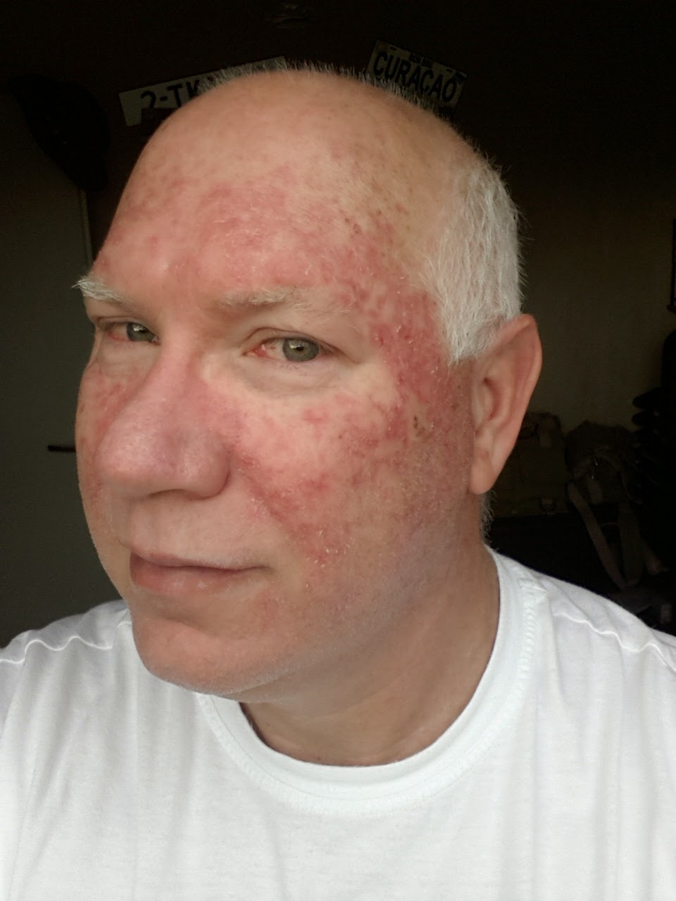 Resultaat gebruik Efudix