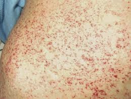 Medical Treatment Pictures-for Better Understanding: Fabry Disease