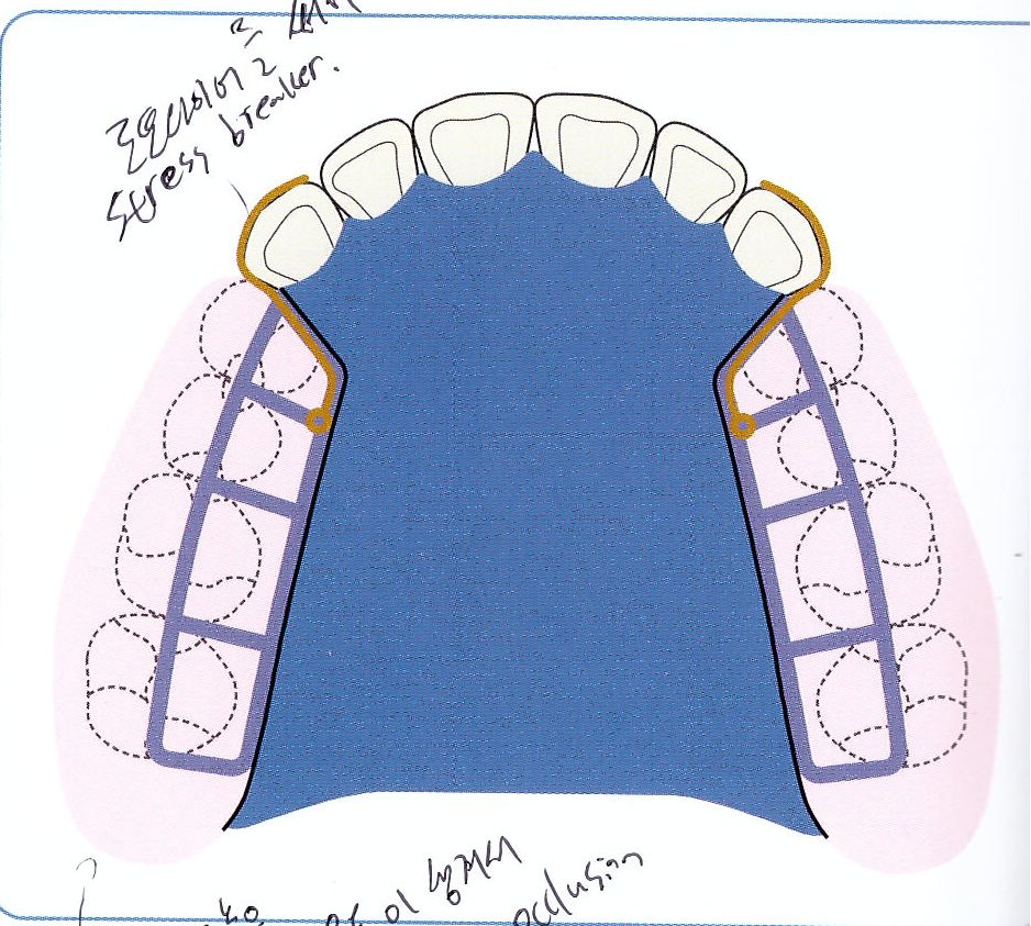 RPD 부분틀니 디자인 kennedy class 1 후방연장 국소의치 ~ Healthy Happy
