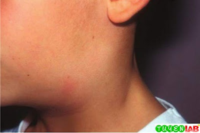 [Pediatric] Atlas of Lymphadenopathy | Free Medical Atlas