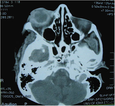 Healthy Ranula: Orbital Cellulitis Diagnosis and Management
