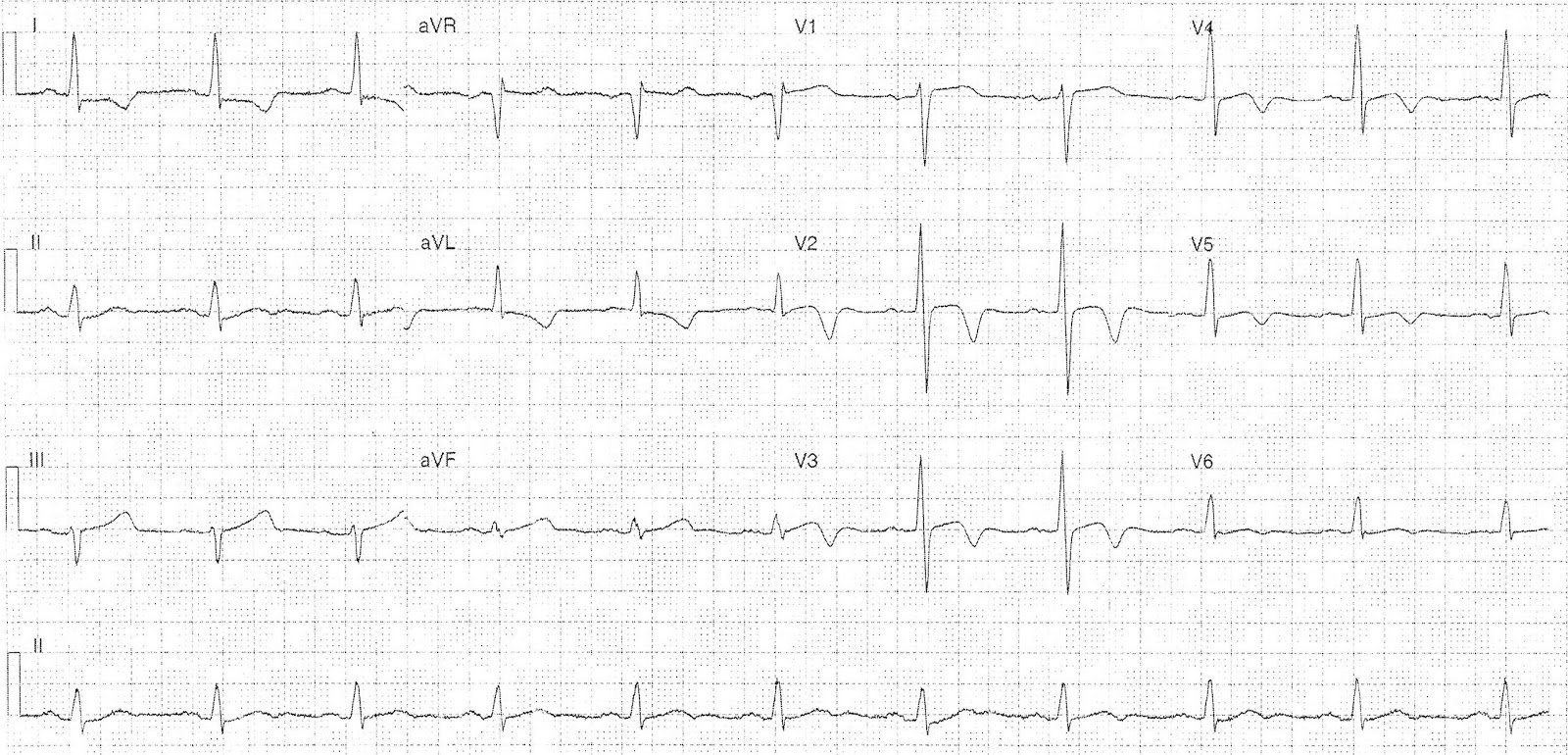 ECG of the Week: ECG of the Week - 3rd September 2018