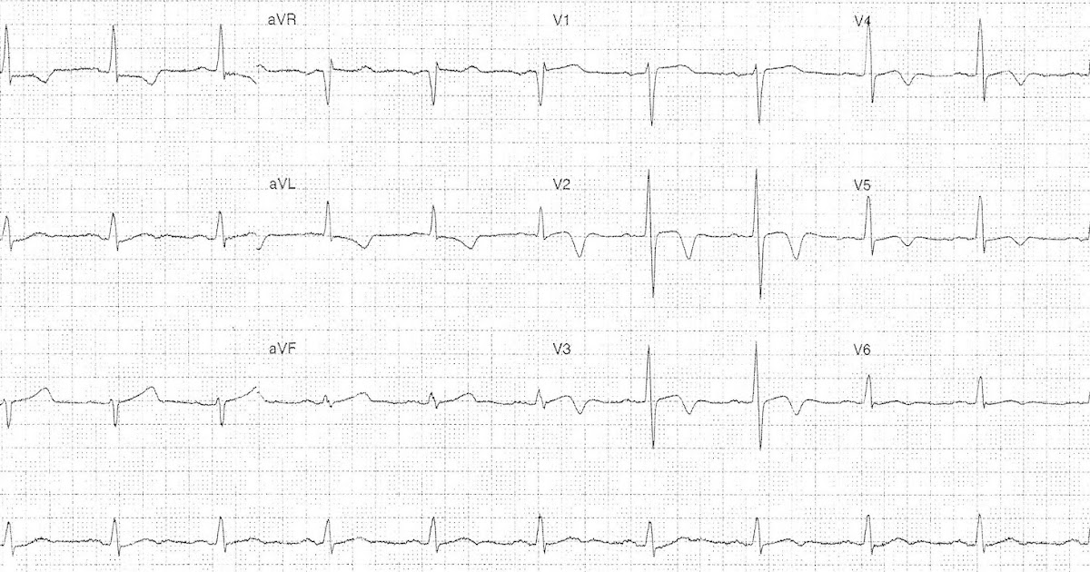 ECG of the Week: ECG of the Week - 3rd September 2018 - Interpretation