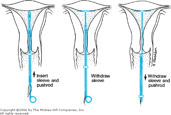 Mengenal Alat Kontrasepsi | Puskesmas Kecamatan Pasar Rebo